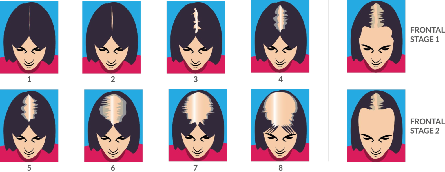 Female Pattern Hair Loss - rockiesdermatology.com